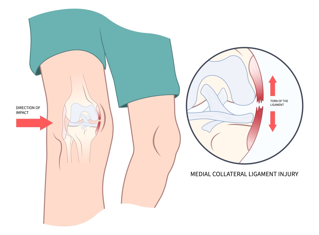 Medial Collateral Ligament (MCL) Injuries | SCOI